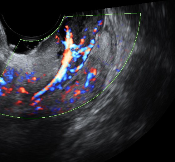 ENDOMETRIAL POLYP WITH A STALK PRESENTING IN THE CERVIX | Looking ...