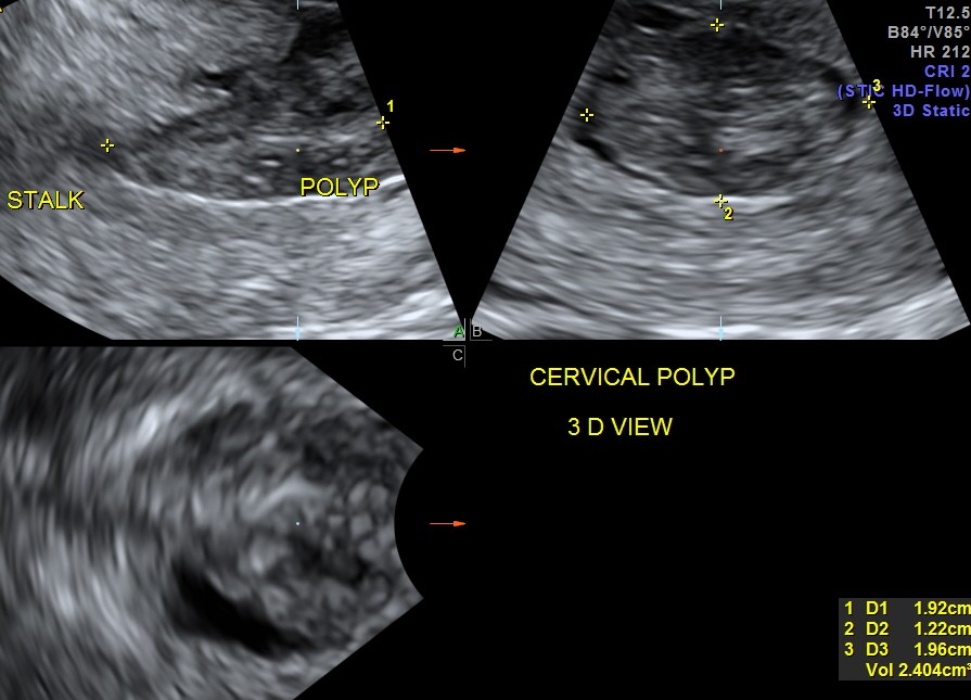 ENDOMETRIAL POLYP WITH A STALK PRESENTING IN THE CERVIX | Looking ...