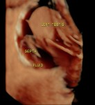 COMPLEX HYDROCELE | Looking Through a Transducer