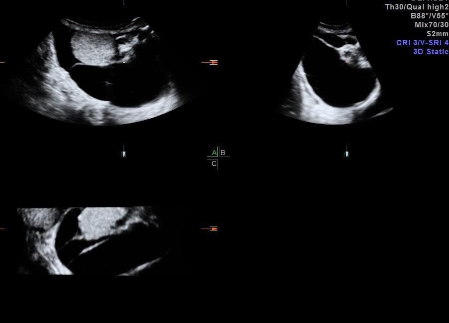 COMPLEX HYDROCELE | Looking Through a Transducer