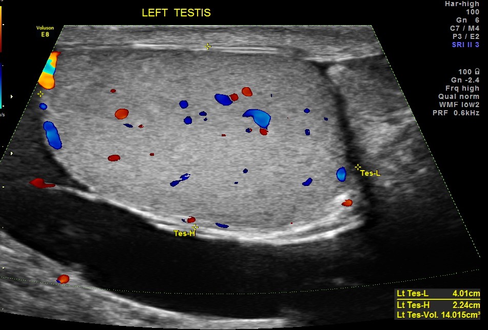 COMPLEX HYDROCELE | Looking Through a Transducer