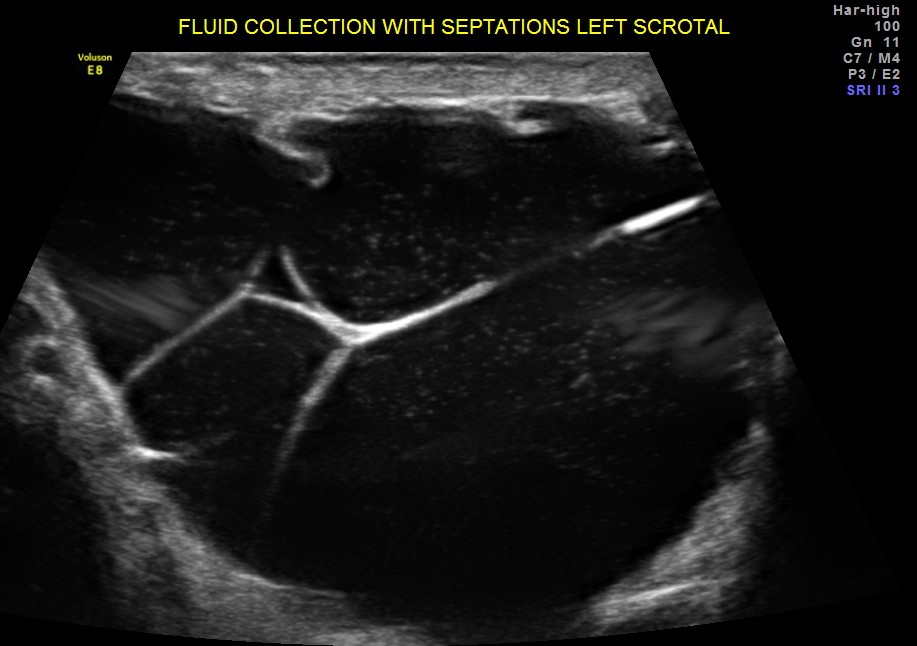 COMPLEX HYDROCELE | Looking Through a Transducer