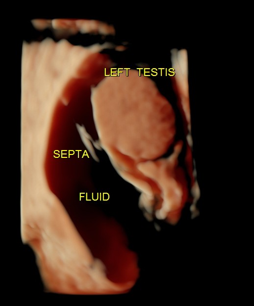 COMPLEX HYDROCELE | Looking Through a Transducer