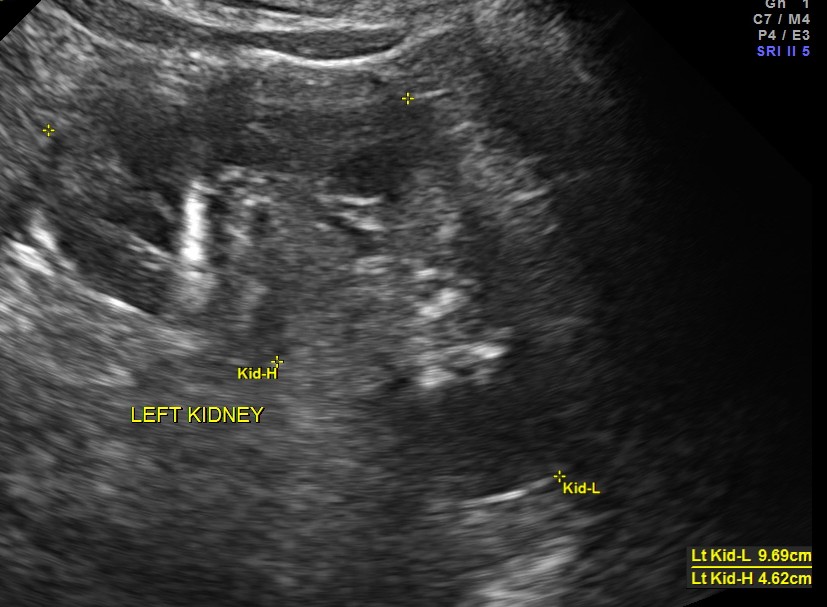 URETEROCELE 3D IMAGES | Looking Through a Transducer