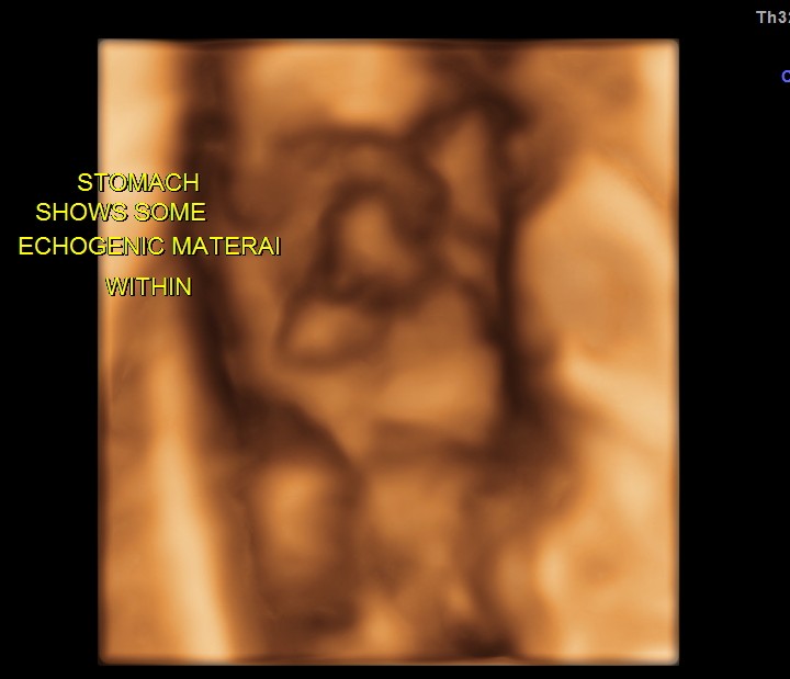 echogenic material within fetal stomach | Looking Through a Transducer