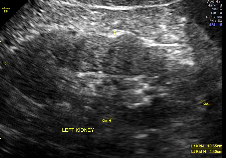Bladder calculus & Prostatomegaly – 2D & 3 D images | Looking Through a ...