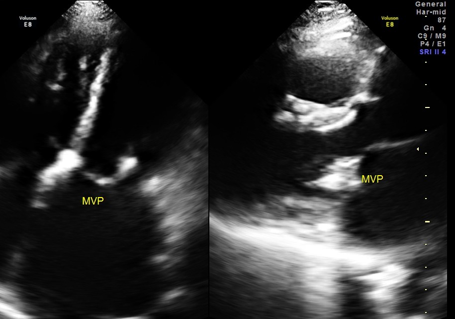 Candle flame sign in mitral stenosis | Looking Through a Transducer