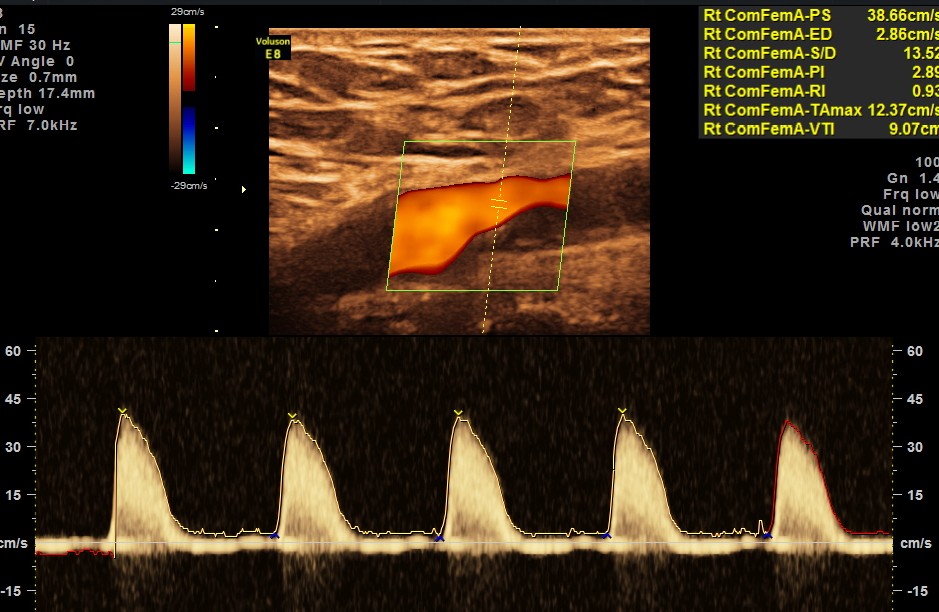 PVD -PERIPHERAL VASCULAR DISEASE | Looking Through a Transducer
