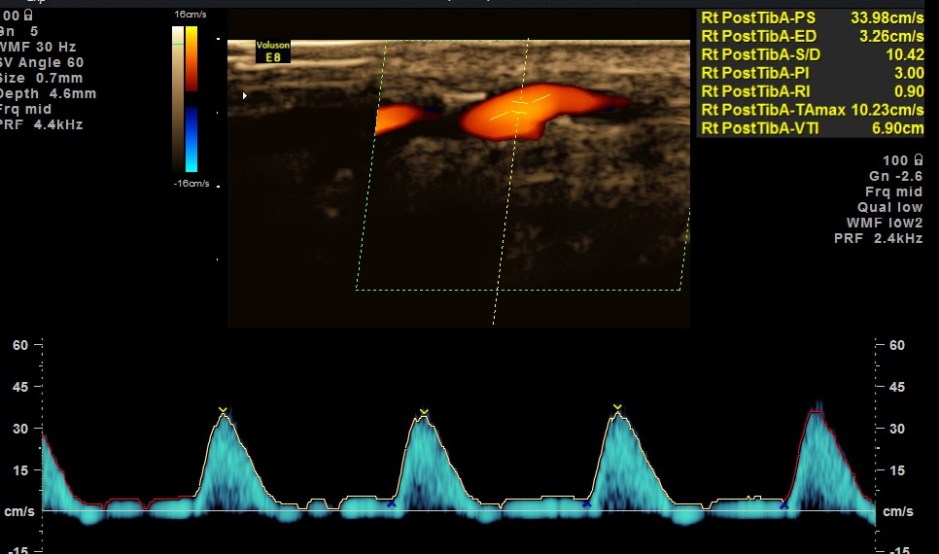 PVD -PERIPHERAL VASCULAR DISEASE | Looking Through a Transducer