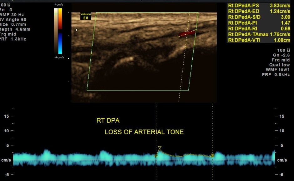 PVD -PERIPHERAL VASCULAR DISEASE | Looking Through a Transducer