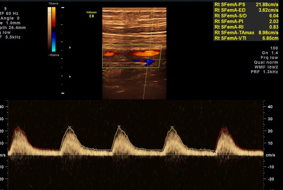 PVD -PERIPHERAL VASCULAR DISEASE | Looking Through a Transducer
