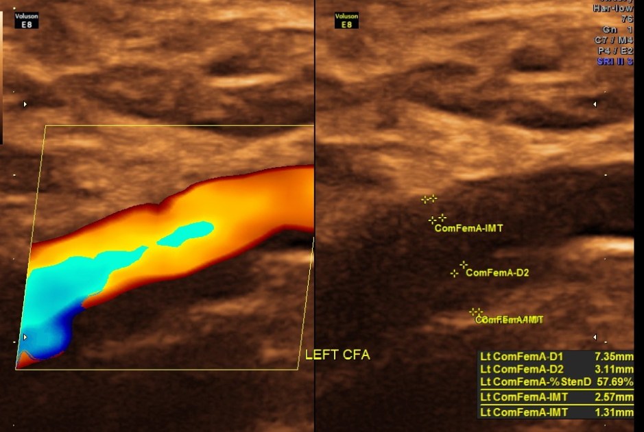 PVD -PERIPHERAL VASCULAR DISEASE | Looking Through a Transducer