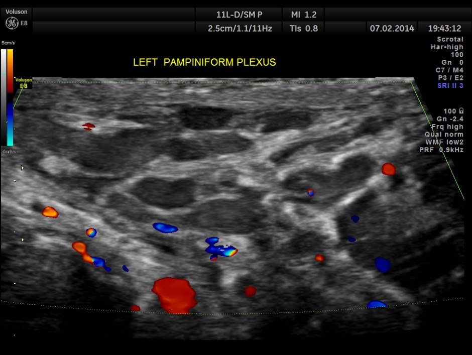 VARICOCELE | Looking Through a Transducer