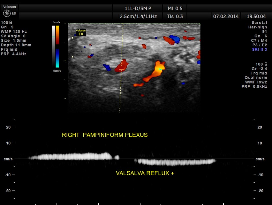 VARICOCELE | Looking Through a Transducer
