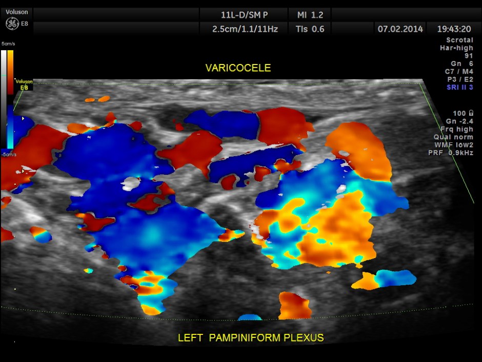 VARICOCELE | Looking Through a Transducer