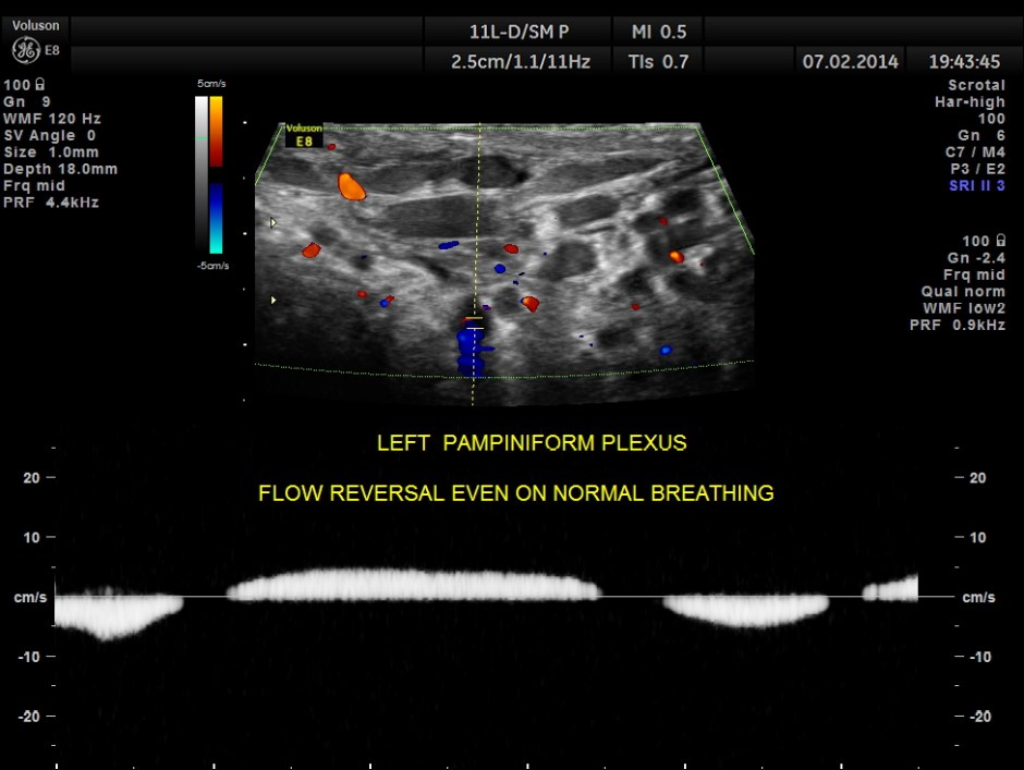 VARICOCELE | Looking Through a Transducer