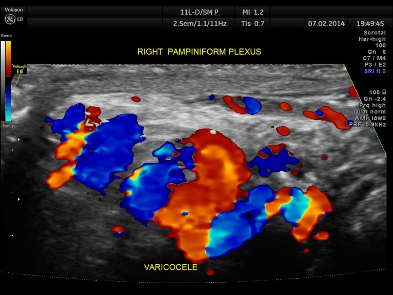 VARICOCELE | Looking Through a Transducer