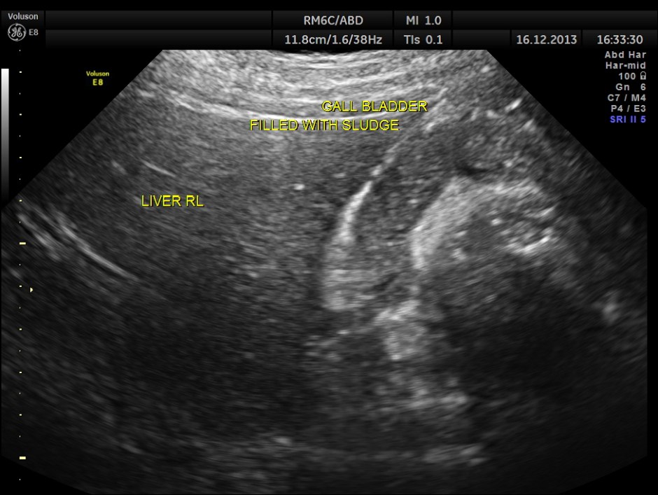 MURPHY’S LAW a.k.a. How straight forward is treating cholecystitis ...