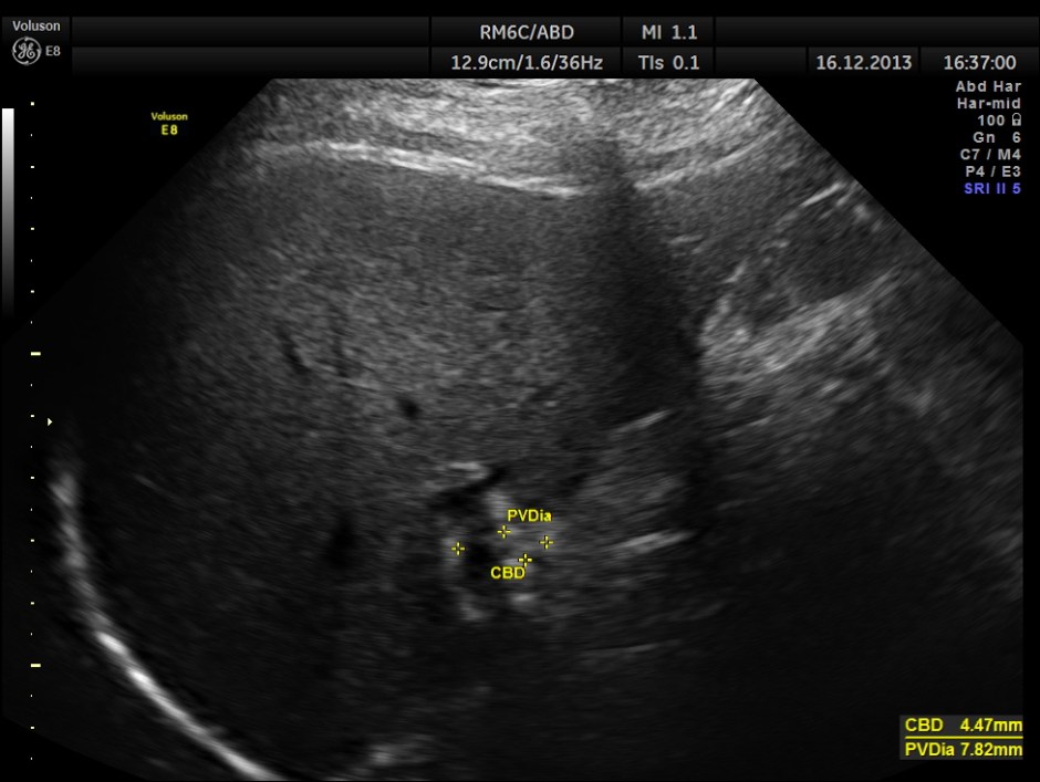 MURPHY’S LAW a.k.a. How straight forward is treating cholecystitis ...