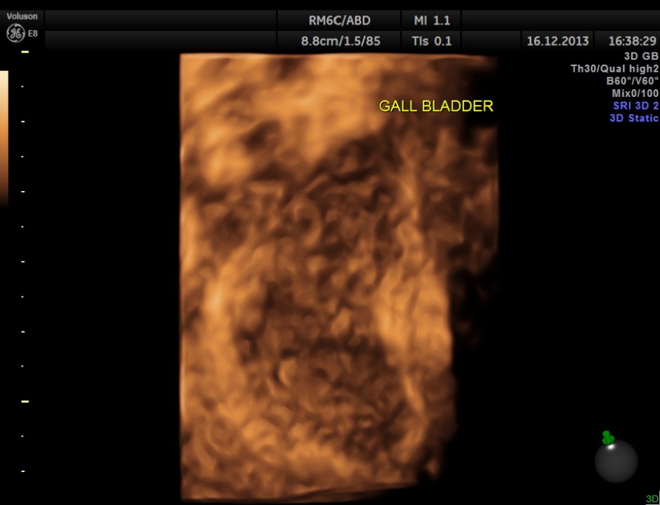 MURPHY’S LAW a.k.a. How straight forward is treating cholecystitis ...