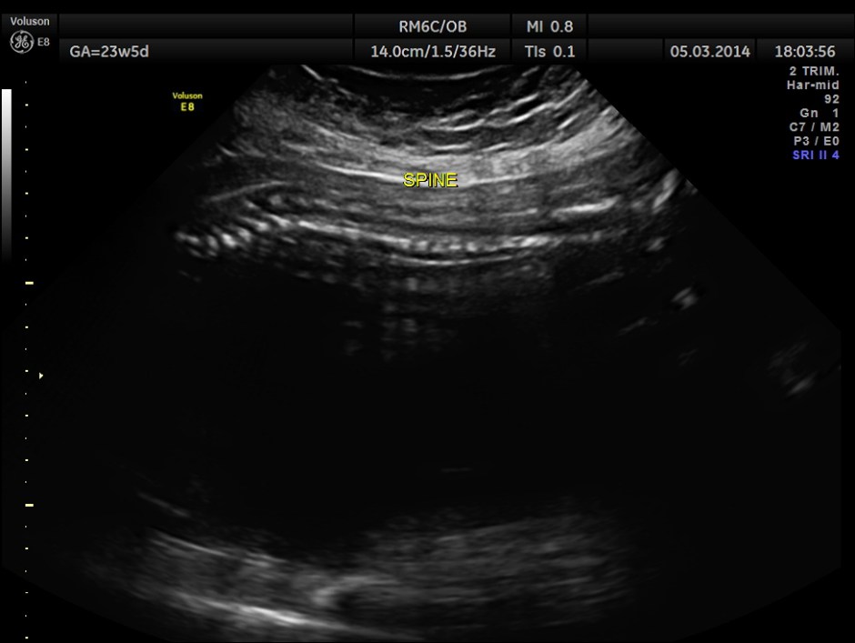 LIMB BODY WALL COMPLEX OR BODY STALK COMPLEX | Looking Through a Transducer