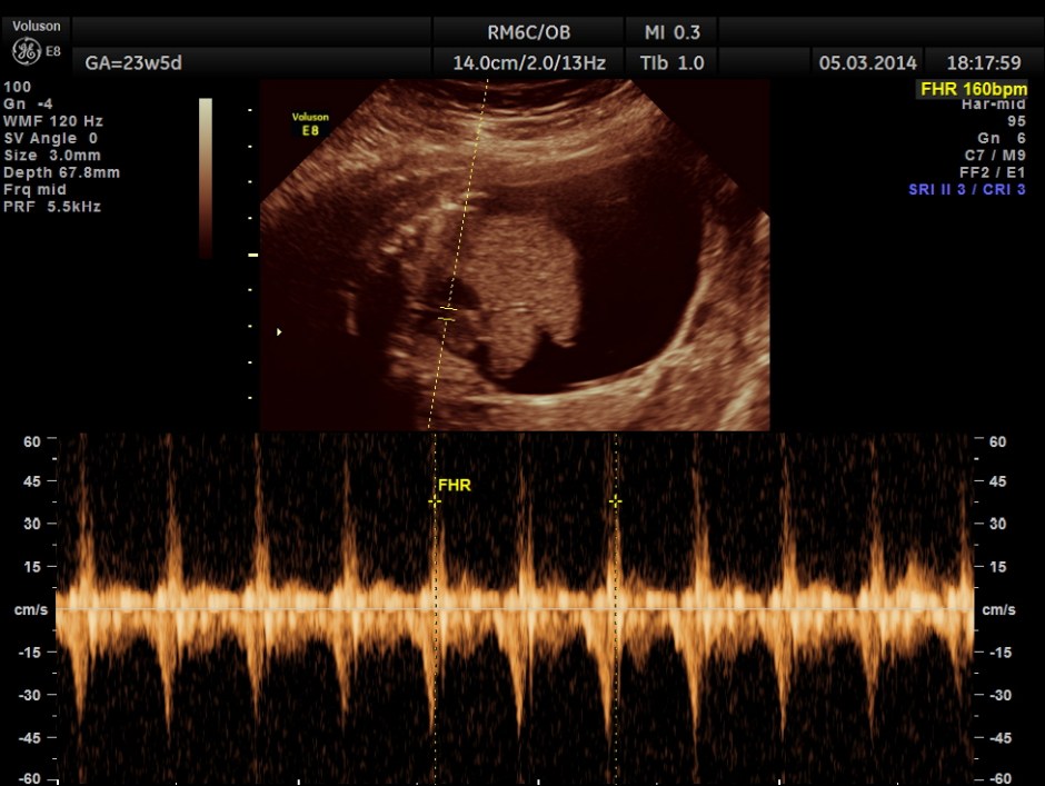 LIMB BODY WALL COMPLEX OR BODY STALK COMPLEX | Looking Through a Transducer