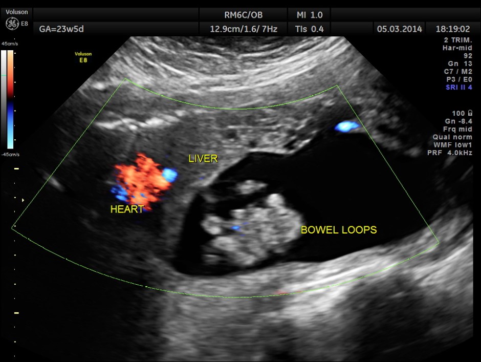 LIMB BODY WALL COMPLEX OR BODY STALK COMPLEX | Looking Through a Transducer