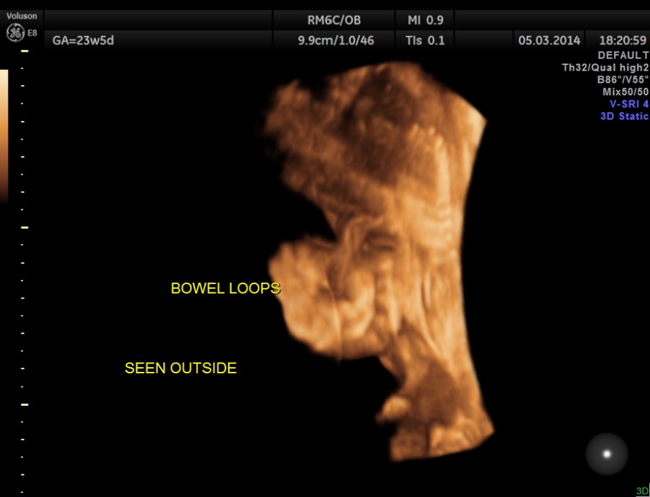 LIMB BODY WALL COMPLEX OR BODY STALK COMPLEX | Looking Through a Transducer