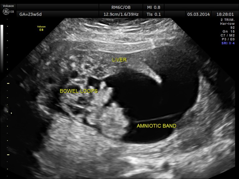 LIMB BODY WALL COMPLEX OR BODY STALK COMPLEX | Looking Through a Transducer