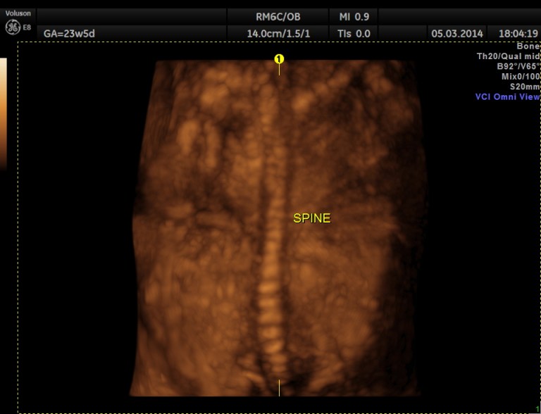 LIMB BODY WALL COMPLEX OR BODY STALK COMPLEX | Looking Through a Transducer