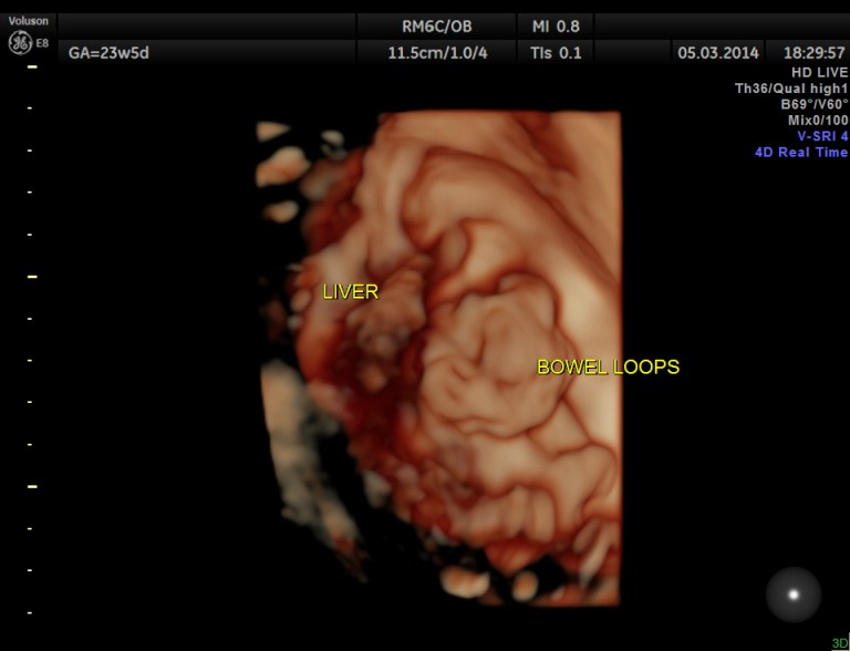 LIMB BODY WALL COMPLEX OR BODY STALK COMPLEX | Looking Through a Transducer