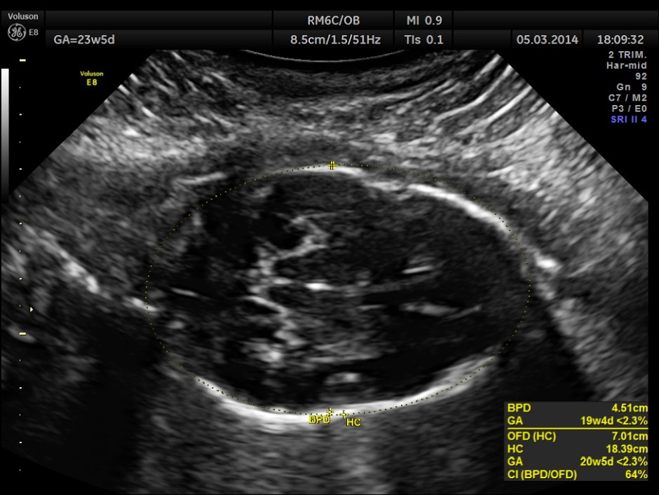 LIMB BODY WALL COMPLEX OR BODY STALK COMPLEX | Looking Through a Transducer