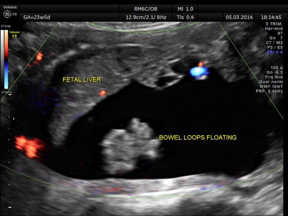 LIMB BODY WALL COMPLEX OR BODY STALK COMPLEX | Looking Through a Transducer