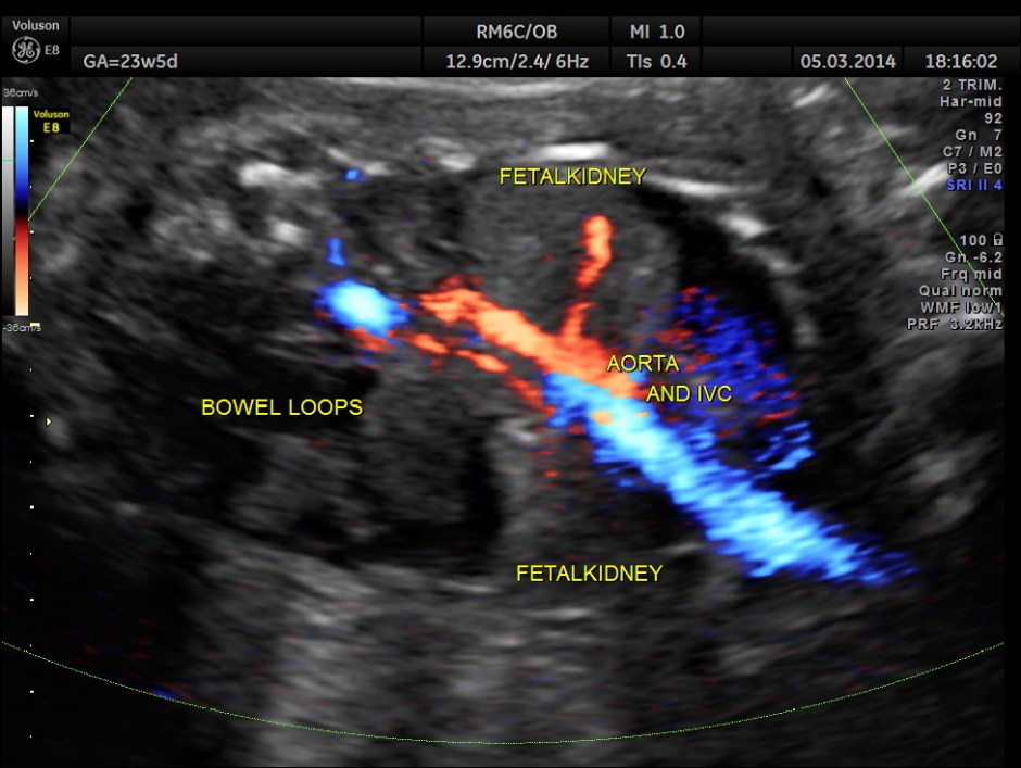 LIMB BODY WALL COMPLEX OR BODY STALK COMPLEX | Looking Through a Transducer