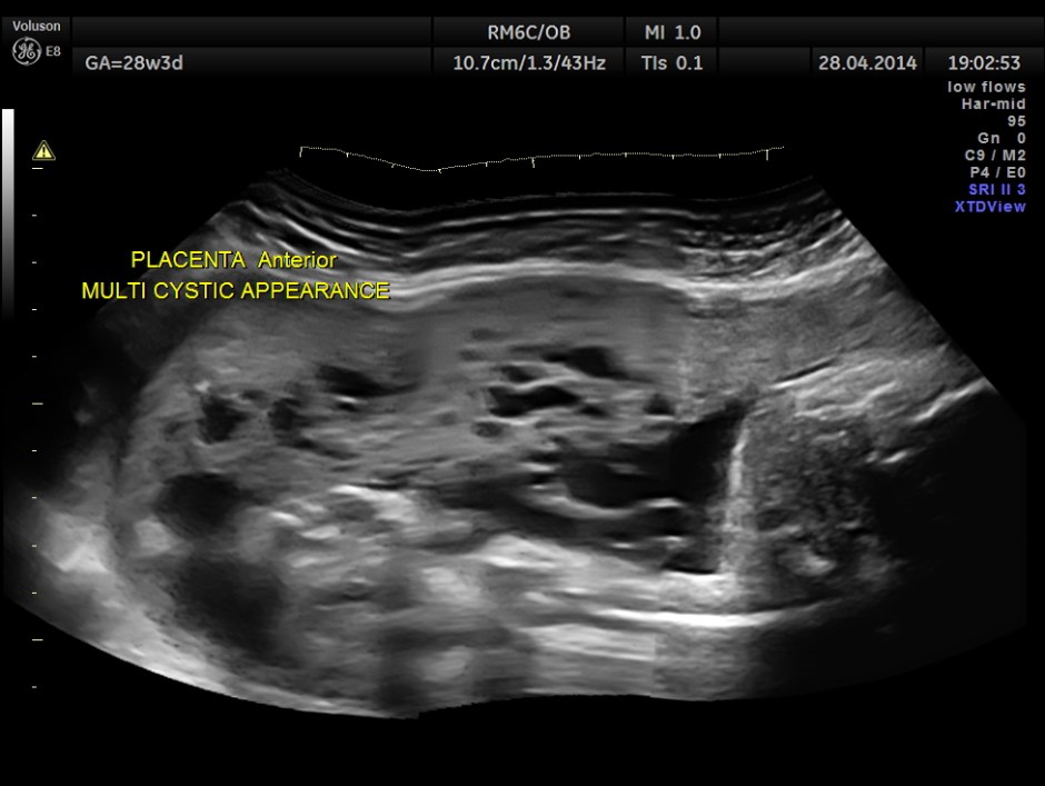 PLACENTAL MASS LESION – PLACENTAL MESENCHYMAL DYSPLASIA – PMD | Looking ...