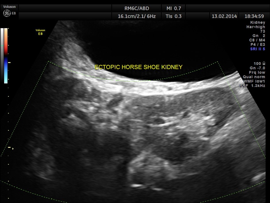 HORSE SHOE KIDNEY IN AN ADULT – INCIDENTAL | Looking Through a Transducer