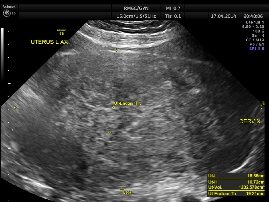 MASSIVE FIBROID ( LEIOMYOMA ) | Looking Through a Transducer