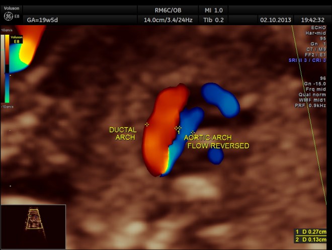 ASYMMETRIC VENTRICLES – LV SMALLER THAN RV – CO-ARCTATION OF AORTA ...