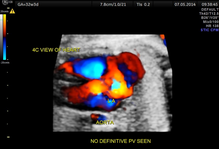 Fetal Echocardiography | Looking Through a Transducer