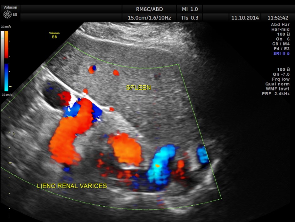 Spleen | Looking Through a Transducer