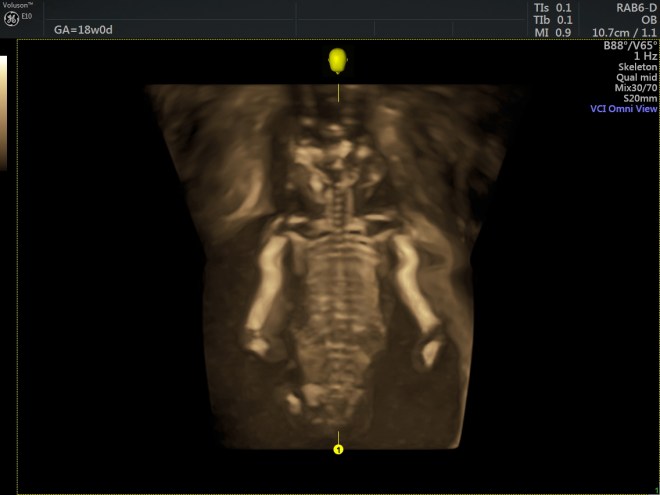 ANENCEPHALY 3D IMAGES | Looking Through a Transducer