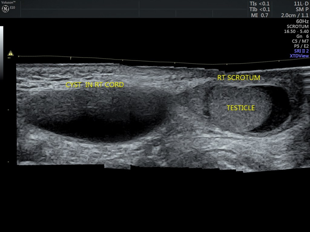 SPERMATIC CORD HYDROCELE | Looking Through a Transducer