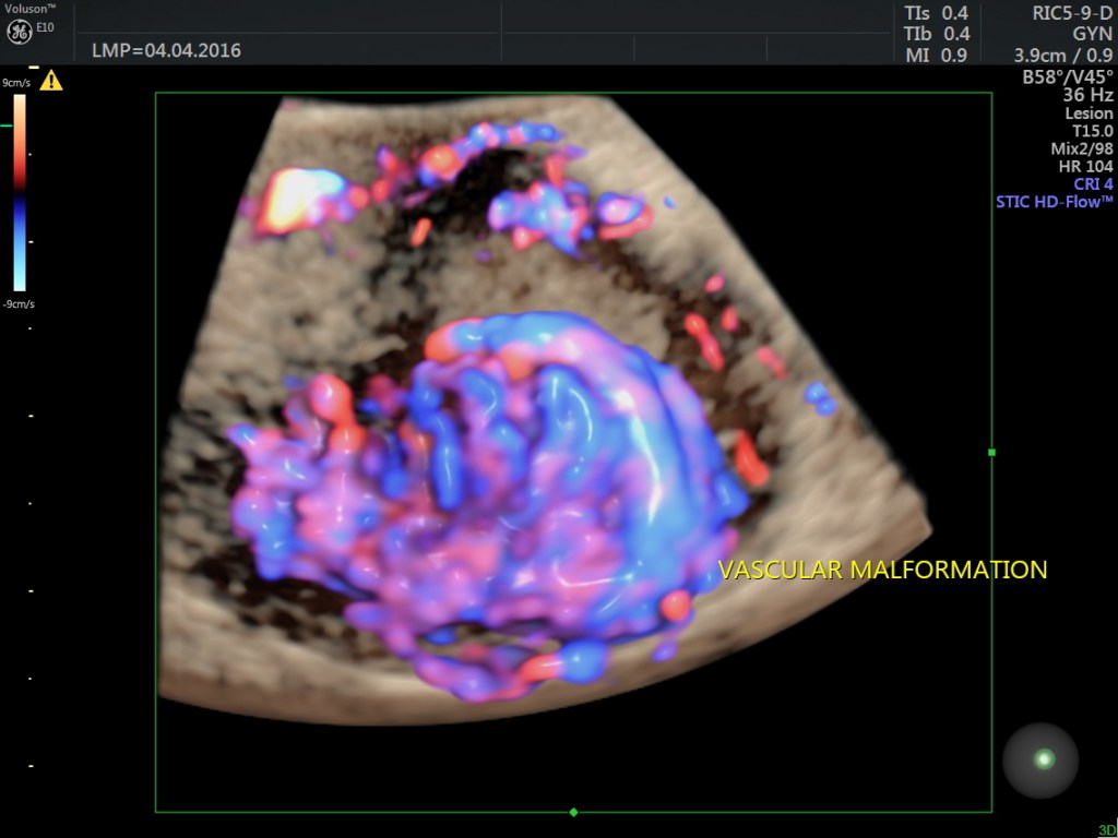 UTERINE ARTERIO-VENOUS MALFORMATION | Looking Through a Transducer