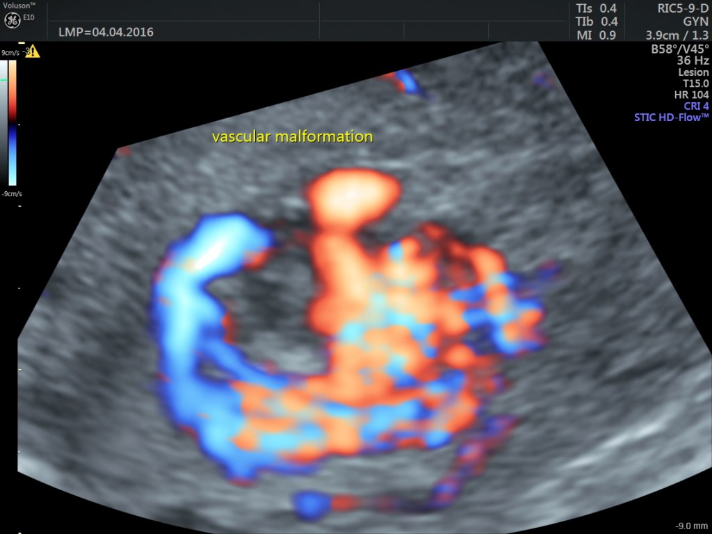 UTERINE ARTERIO-VENOUS MALFORMATION | Looking Through a Transducer