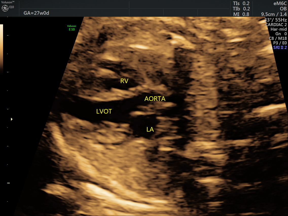 Rt aortic arch and aberrant left subclavian artery | Looking Through a ...