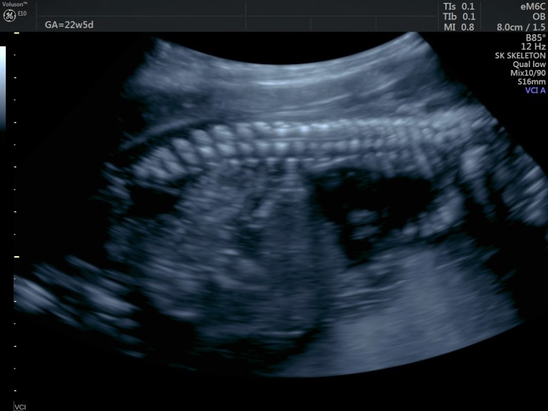 CONJOINED TWINS | Looking Through a Transducer