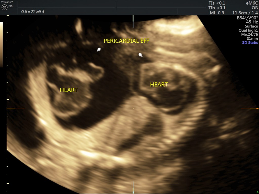CONJOINED TWINS | Looking Through a Transducer